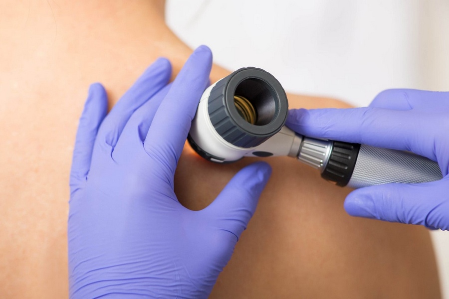The Right Time to Get Skin Cancer Test Done - greatmanagement